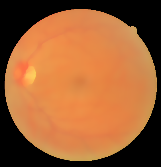 Retinal Fundus Image Enhancement With Image Decomposition | Dibyajyoti Jena